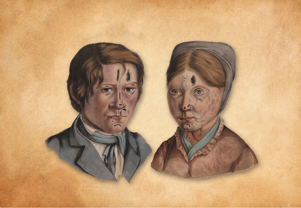 Lepra: Noorse arts loste het mysterie van de ziekte op | Historianet.nl