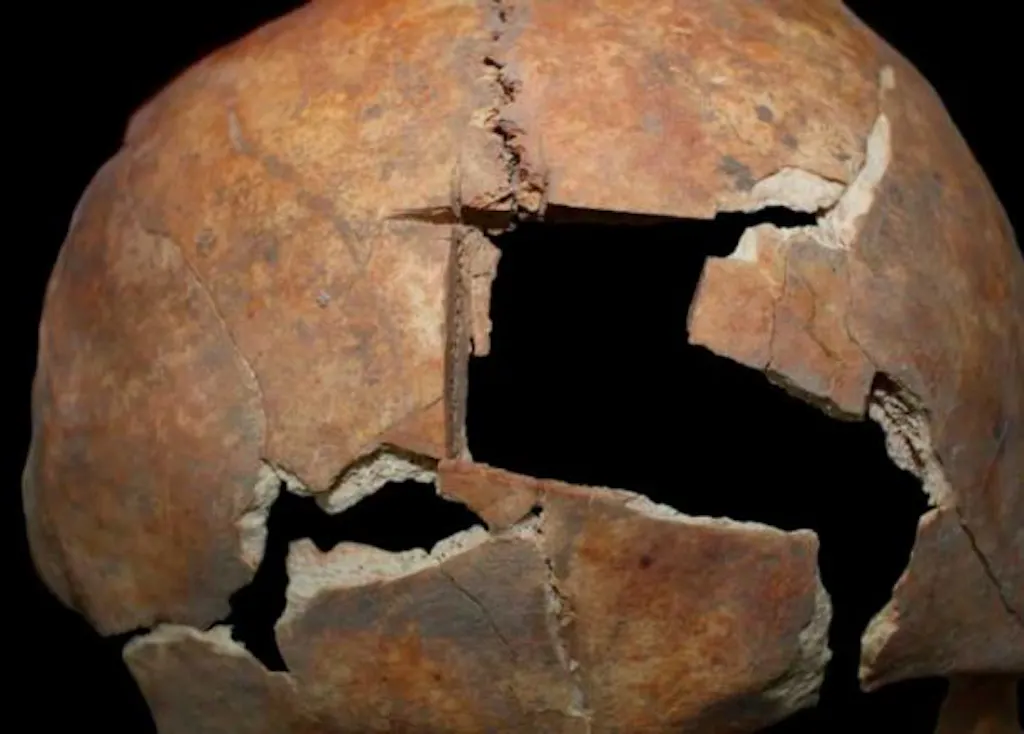 Grusom hjernekirurgi skulle redde rigmand fra spedalskhed | historienet.dk