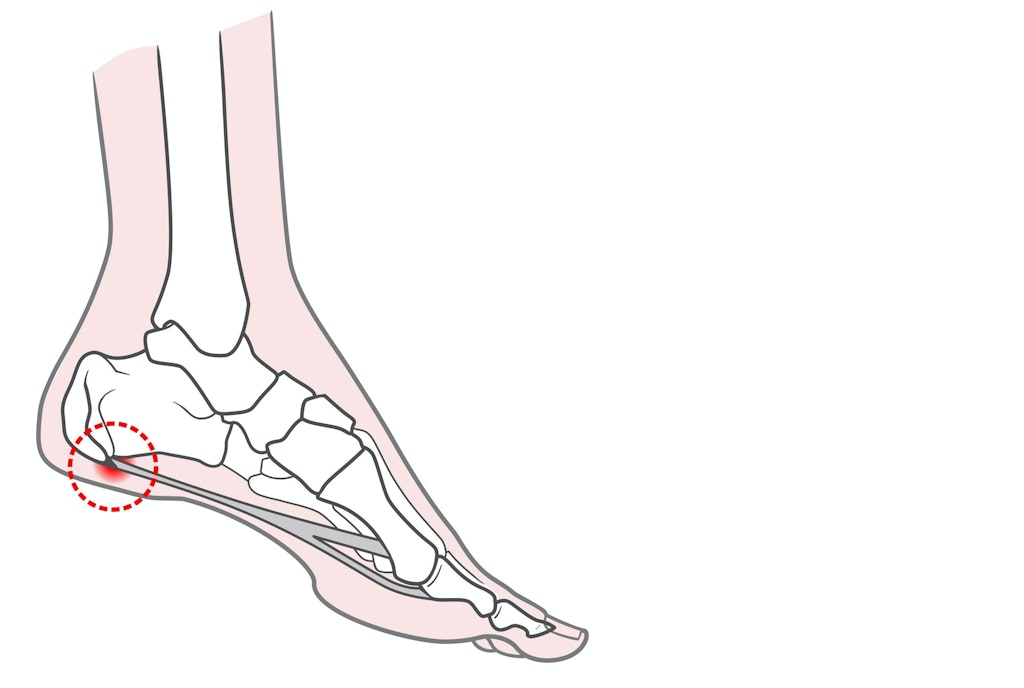 Hælspore | De beste øvelser mot vondt i hælen | I FORM