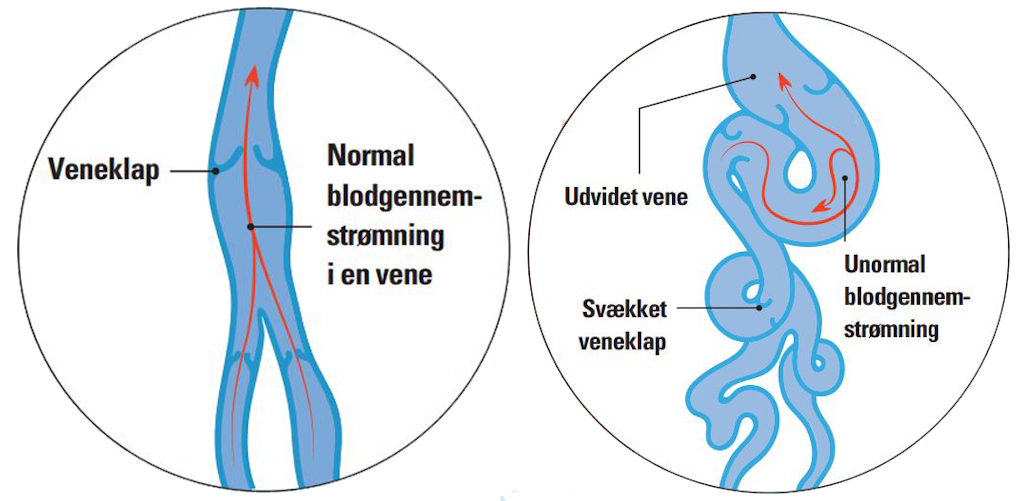 Vand i benene – sådan slipper du af med væsken | I FORM