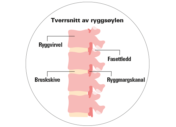 Vondt i korsryggen? Slik blir du kvitt smerter i korsryggen | iform.nu