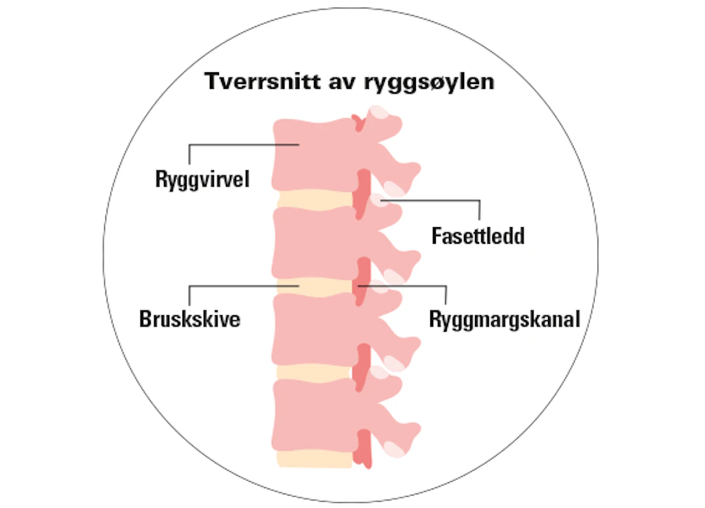 Vondt i korsryggen? Slik blir du kvitt smerter i korsryggen | I FORM