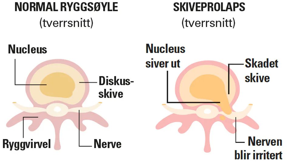 Vondt i korsryggen? Slik blir du kvitt smerter i korsryggen | iform.nu