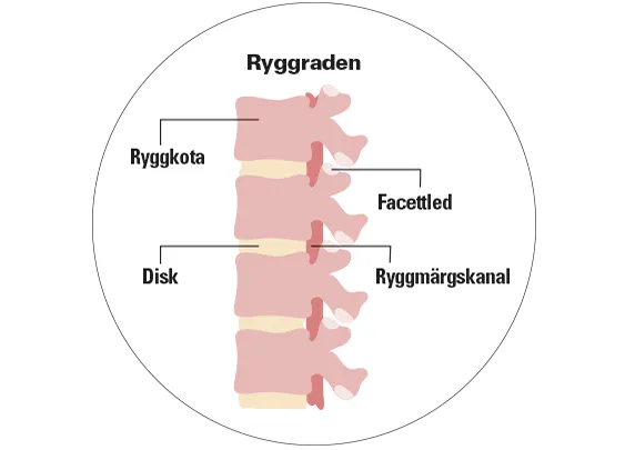 Ont i ländryggen? Så här blir du av med smärtor i ländryggen? | iform.se