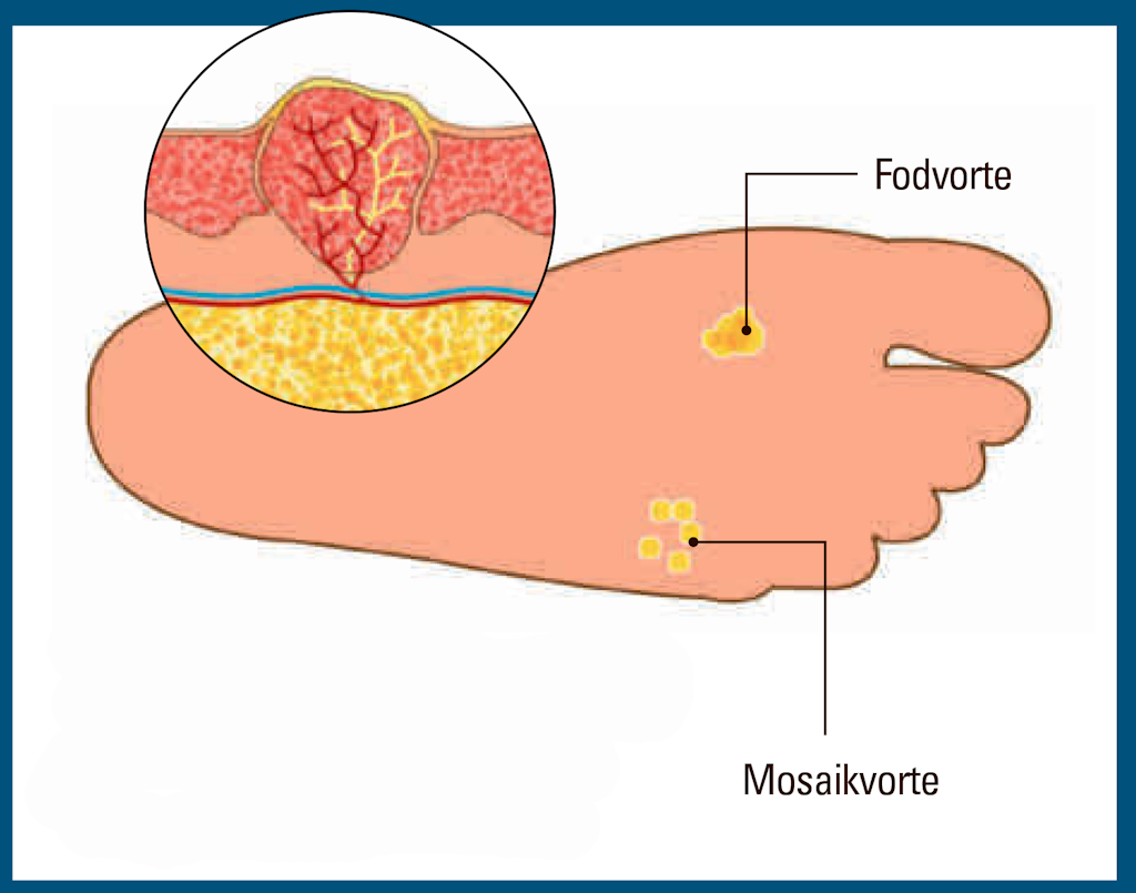 Fodvorter – sådan smitter de, og sådan fjerner du dem | I FORM