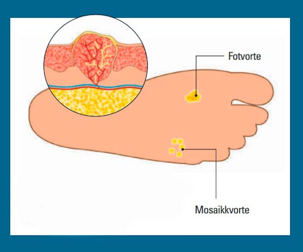 Fotvorter – slik smitter de, og slik fjerner du dem | I FORM