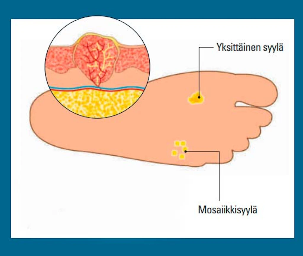 Jalkapohjan syylä – näin se tarttuu ja näin siitä pääsee eroon | KUNTO PLUS