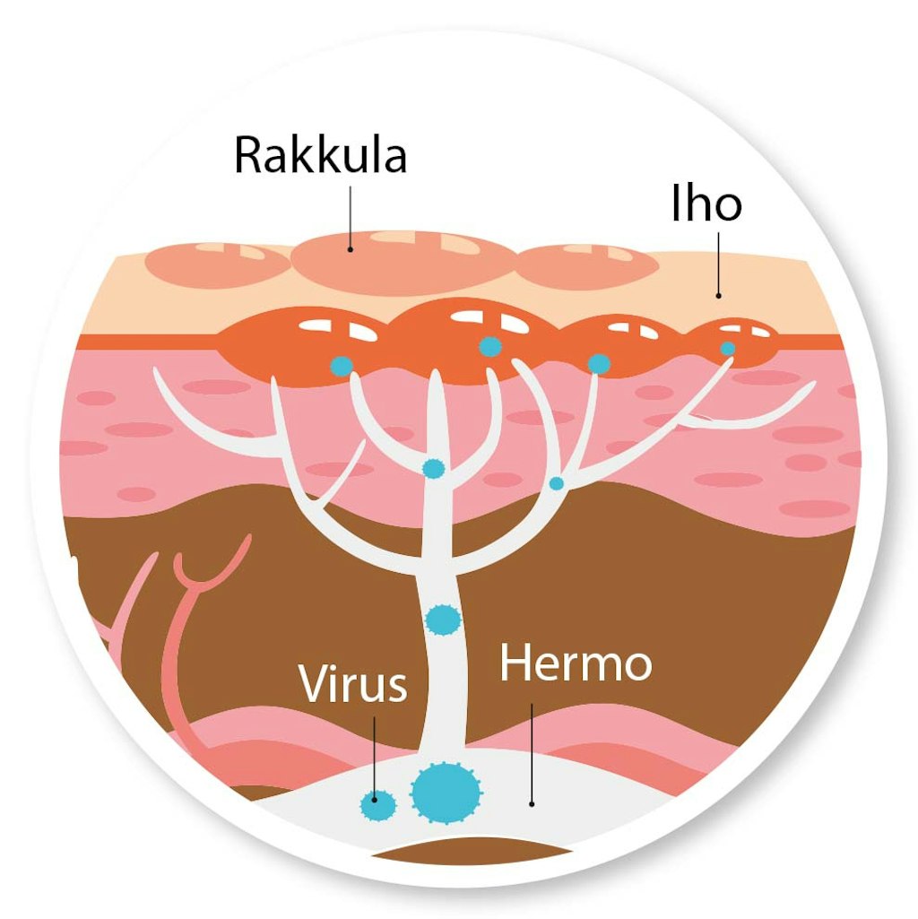 Vyöruusu – näin voit lievittää ja ehkäistä rakkuloita | KUNTO PLUS