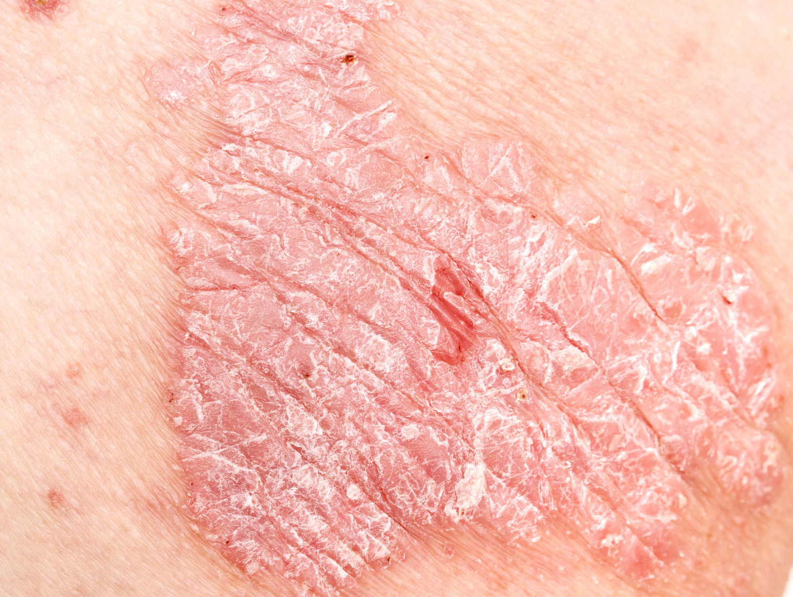 Psoriasis – få svar på 13 viktiga frågor om psoriasis | iform.se