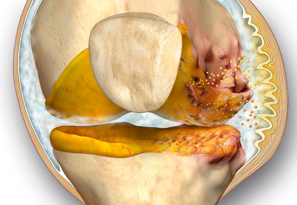 Stamceller kurerer giktrammede knær | illvit.no