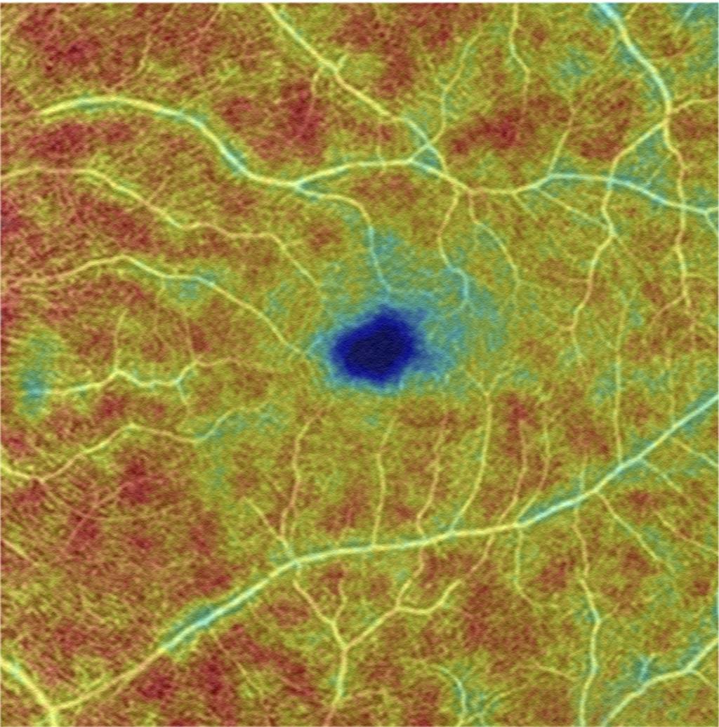 Dina ögon avslöjar om du får Alzheimers sjukdom | illvet.se