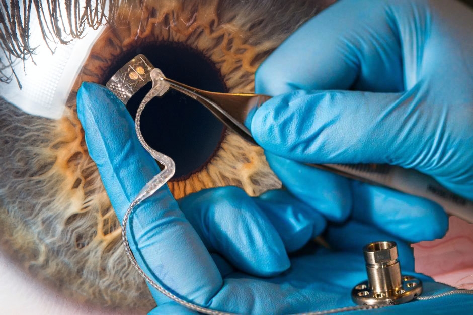 Blindhed – Sådan bekæmper vi blindhed med transplantationer | illvid.dk