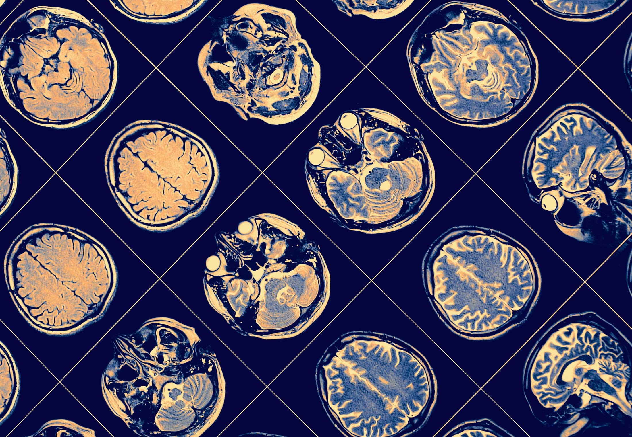 Wat is een hersenschudding en is het gevaarlijk voor je hersenen ...