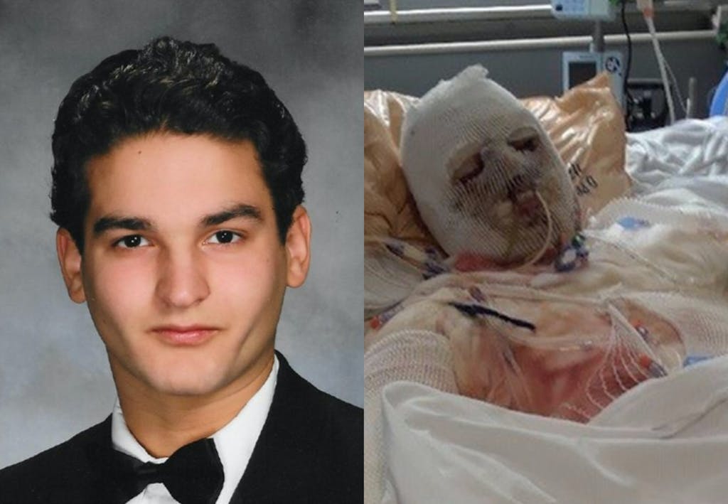 Verdens første dobbelt-transplantation af hænder og ansigt | illvid.dk