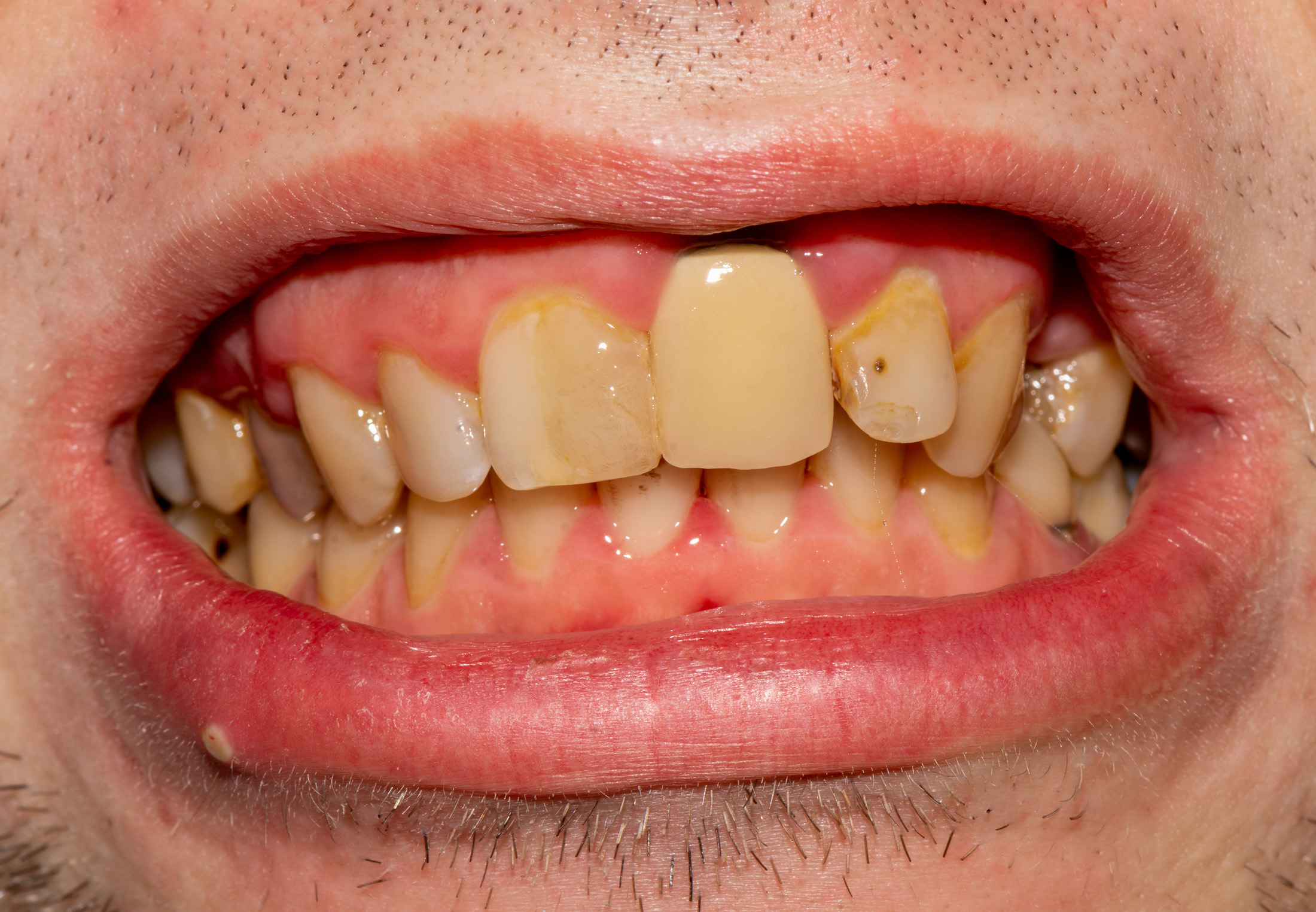 Dåliga tänder kan leda till döden | illvet.se