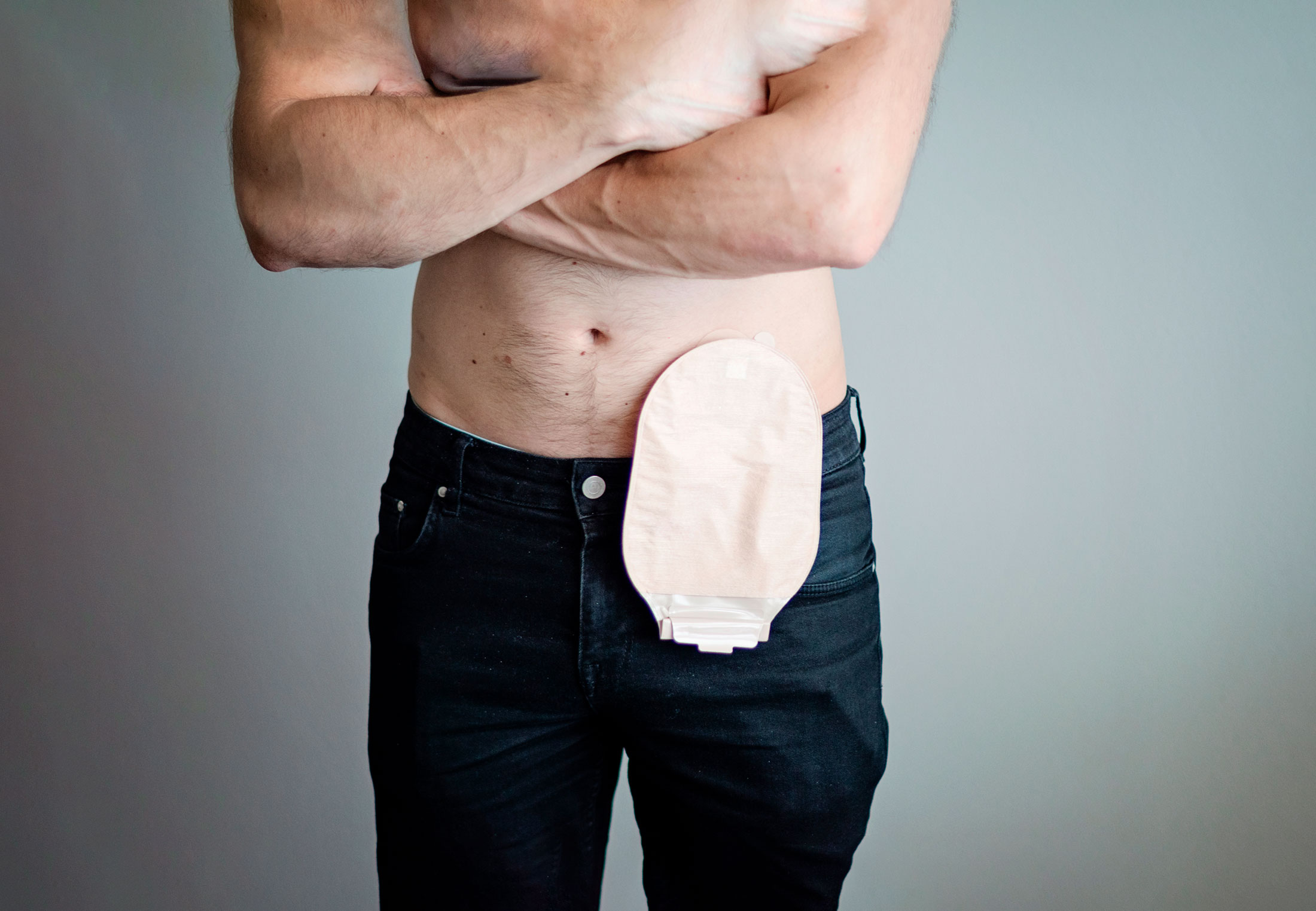 Så fungerar en stomipåse | illvet.se