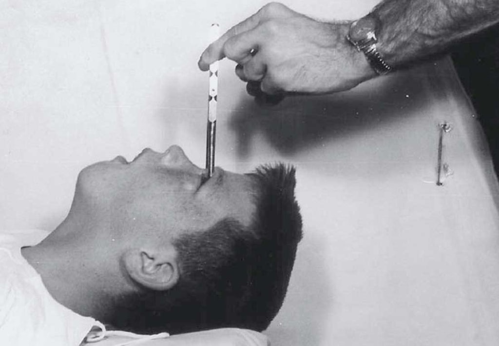 Lobotomi – syl i hjernen forvandlet folk til zombier | illvit.no