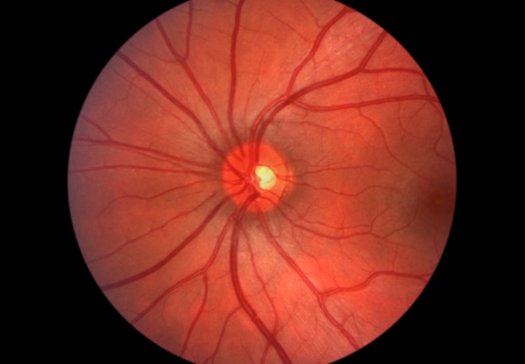 Hjärtstopp – Dina ögon avslöjar risken | illvet.se