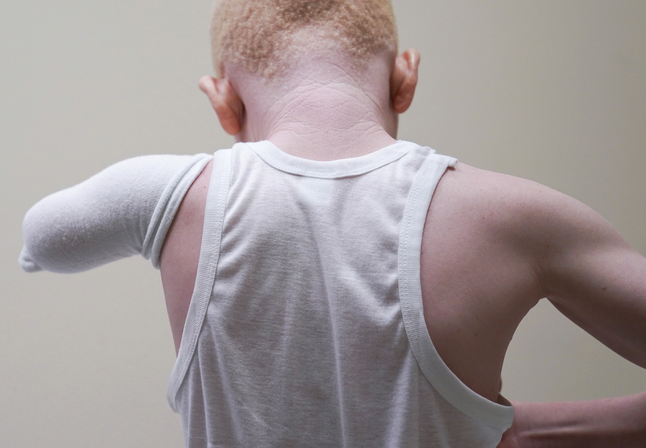 Albinism - Genmutation gör albiner vita | illvet.se