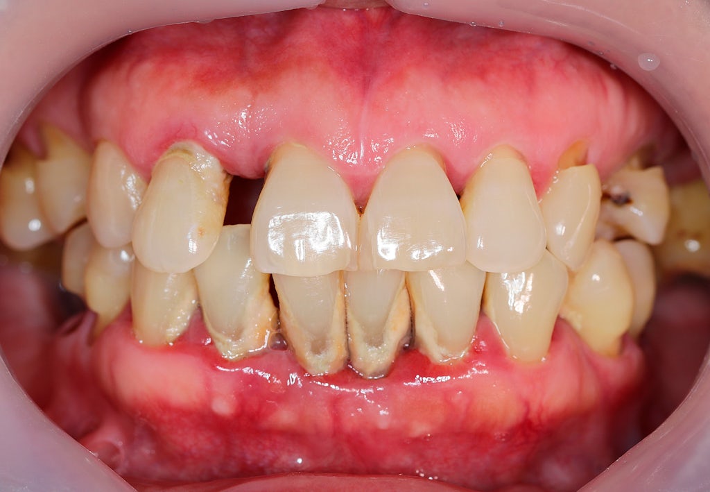 Hvad er miltens funktion og har du brug for den? | illvid.dk