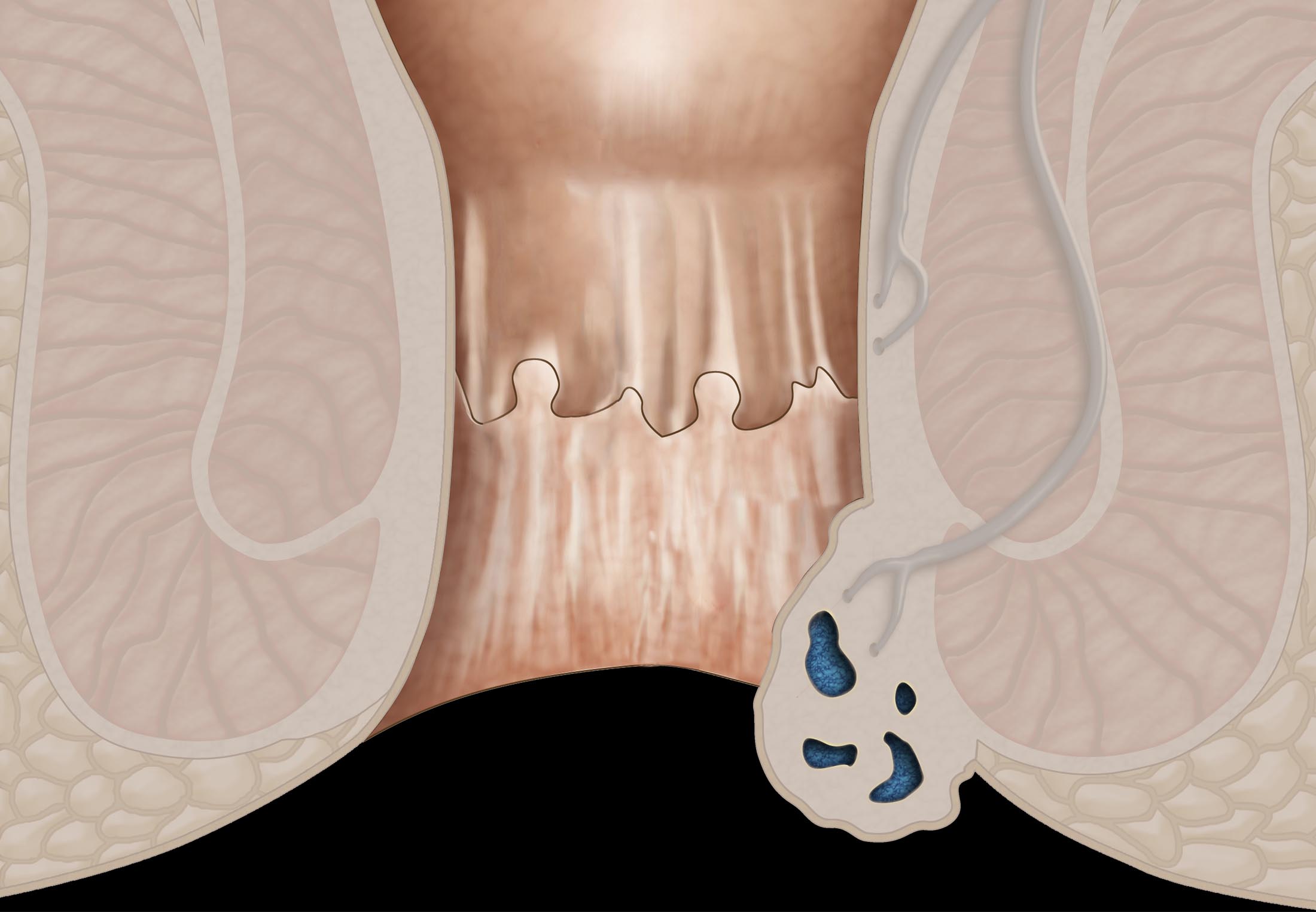 Hvordan opstår hæmorider? | illvid.dk