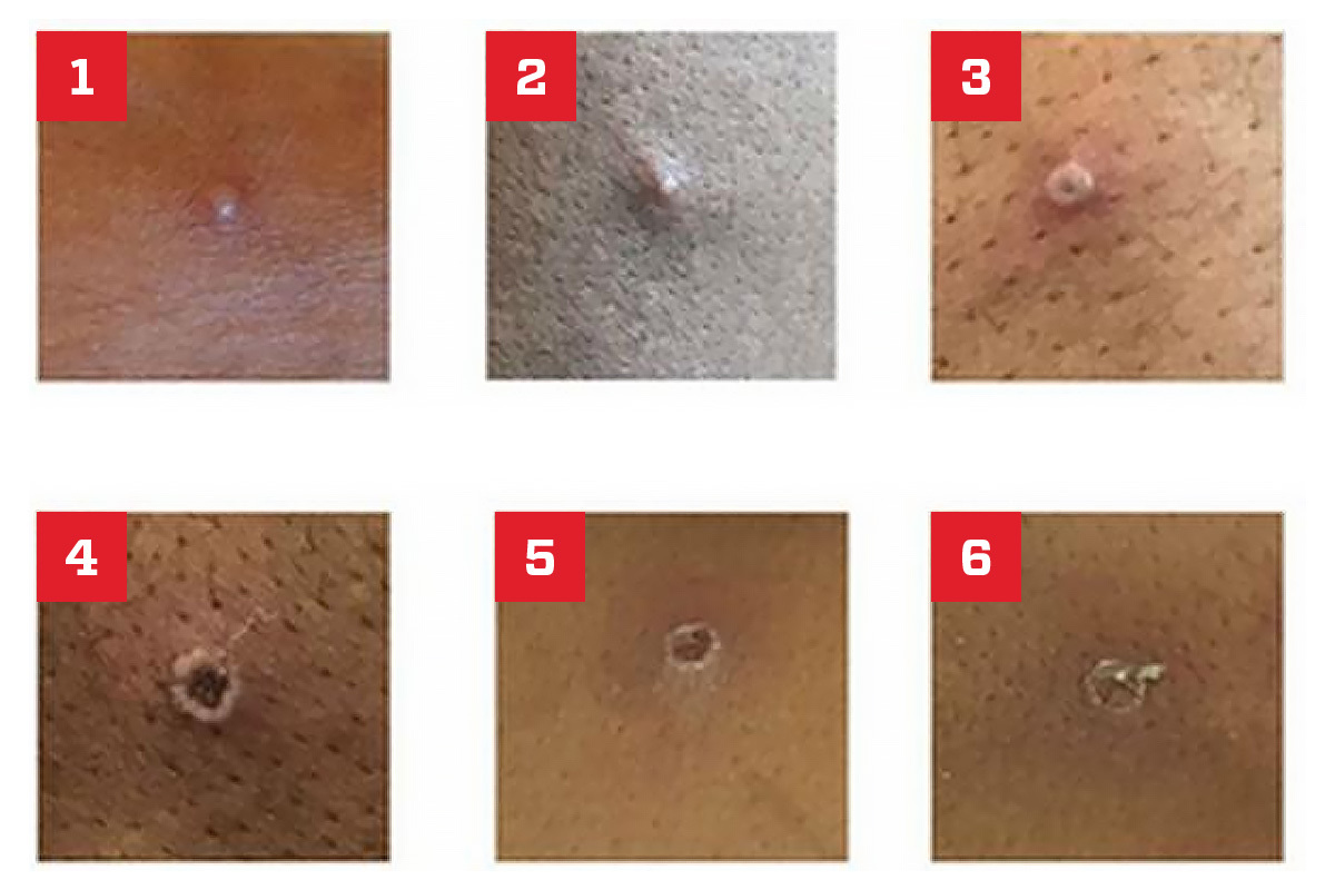 Apenpokken - Overzicht over symptomen en verspreiding | wibnet.nl