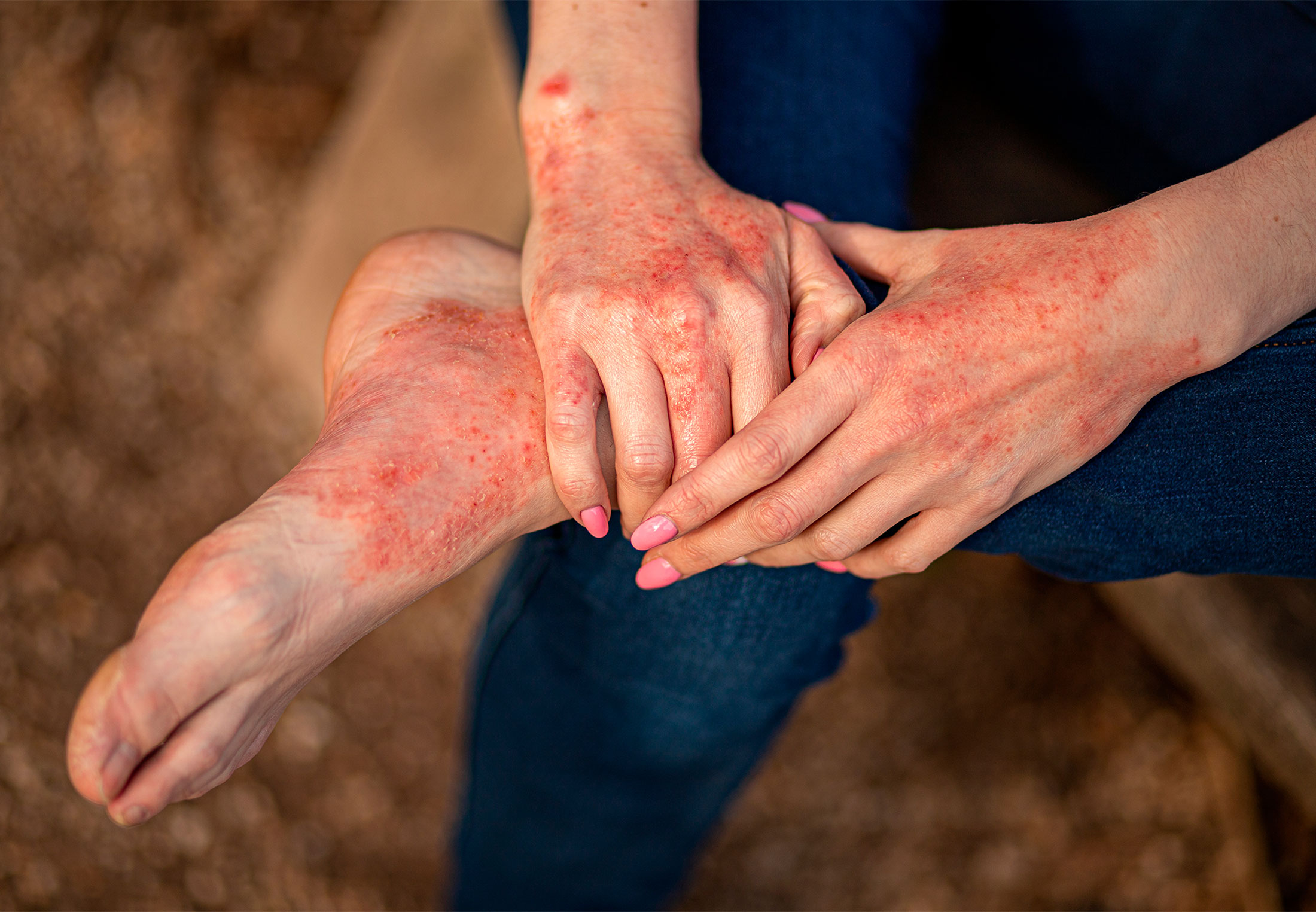 Atopiskt eksem ökar risken för ätstörningar | illvet.se