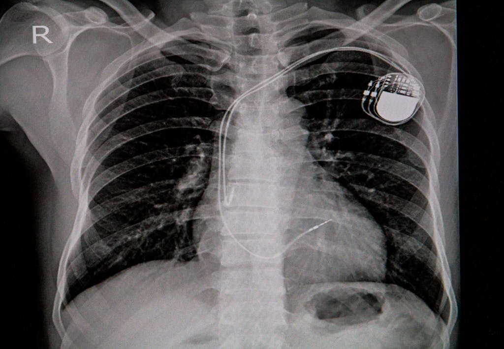 Researchers are developing a pacemaker that does not require a battery ...
