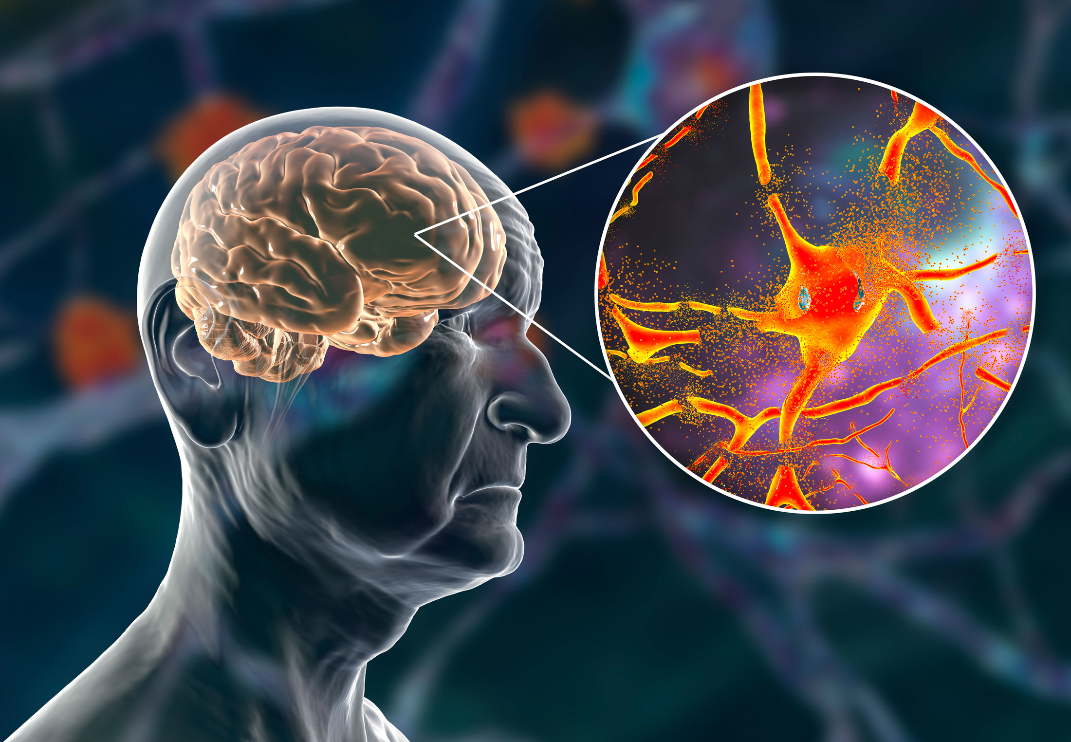 Forskare har hittat fem versioner av Alzheimers sjukdom | illvet.se