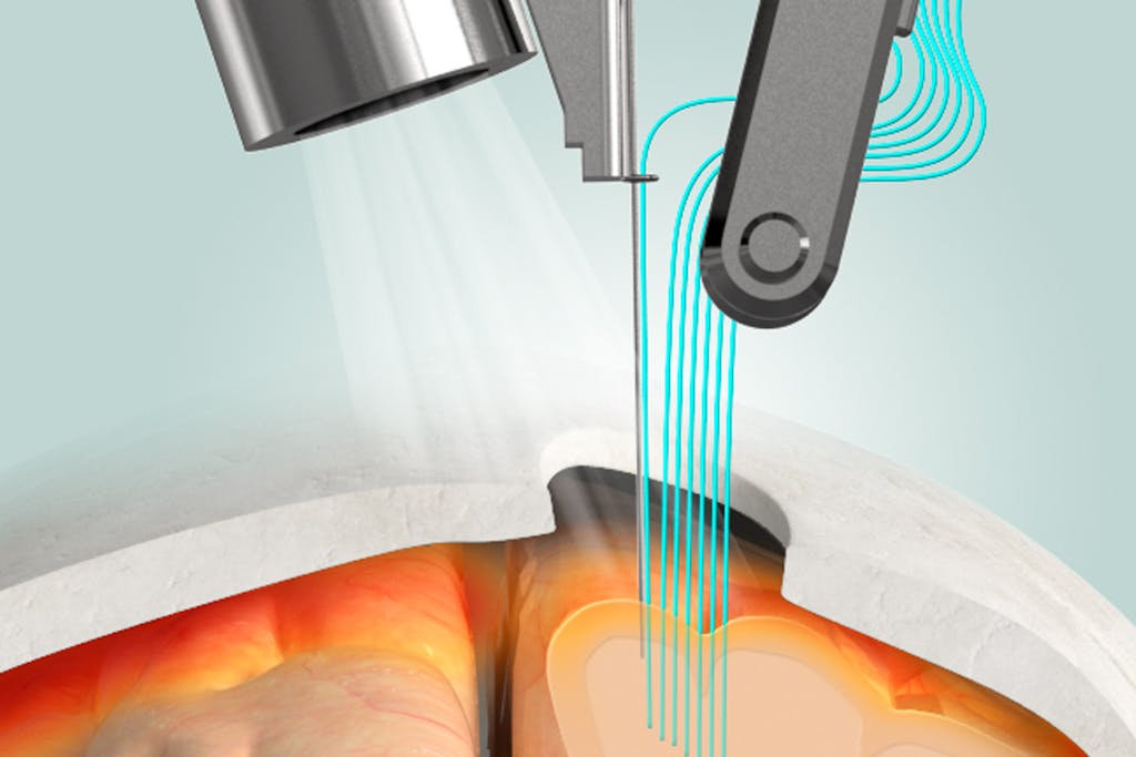 Neuralink: Dit moet je weten over het nieuwe hersenimplantaat | wibnet.nl