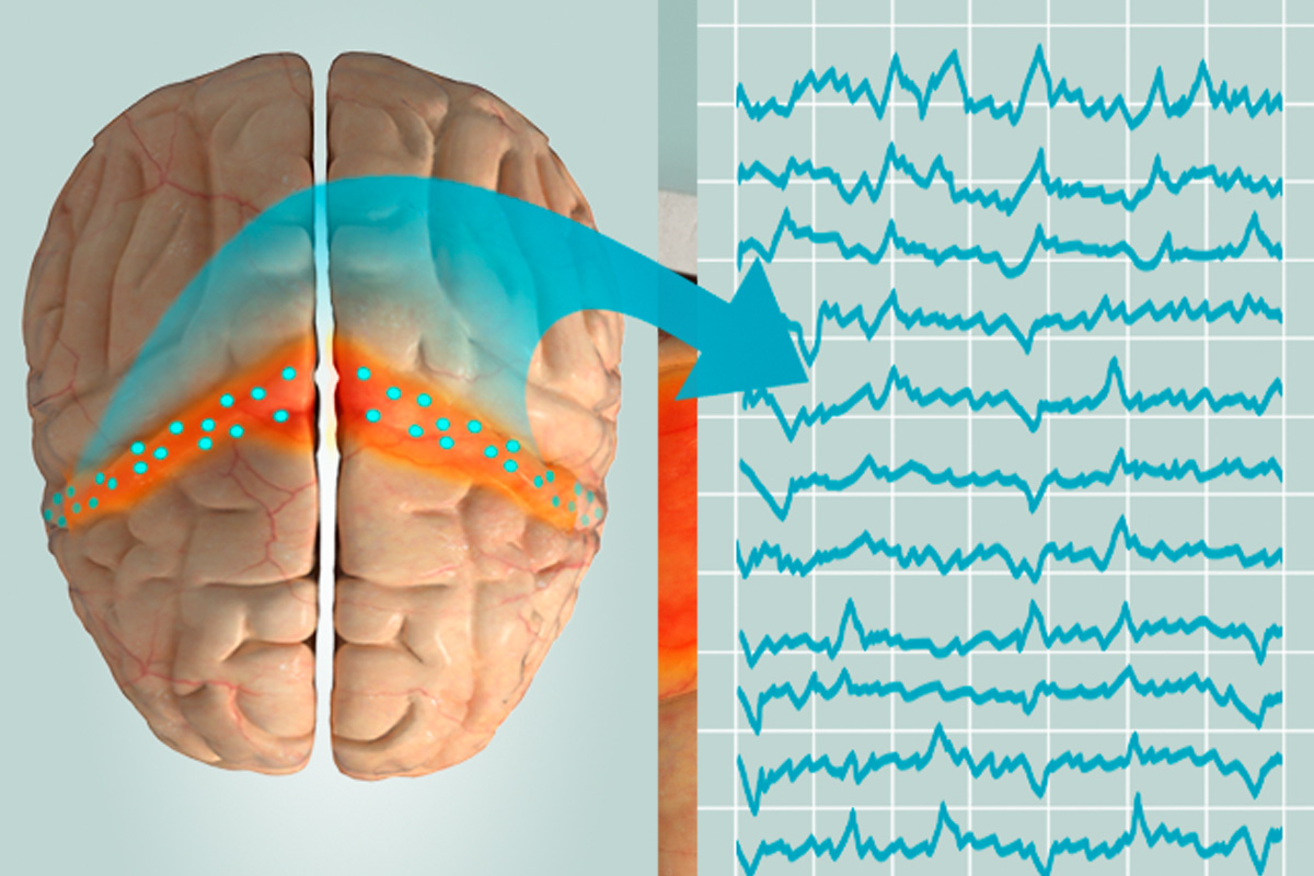 Neuralink: what you need to know about the new brain implant ...