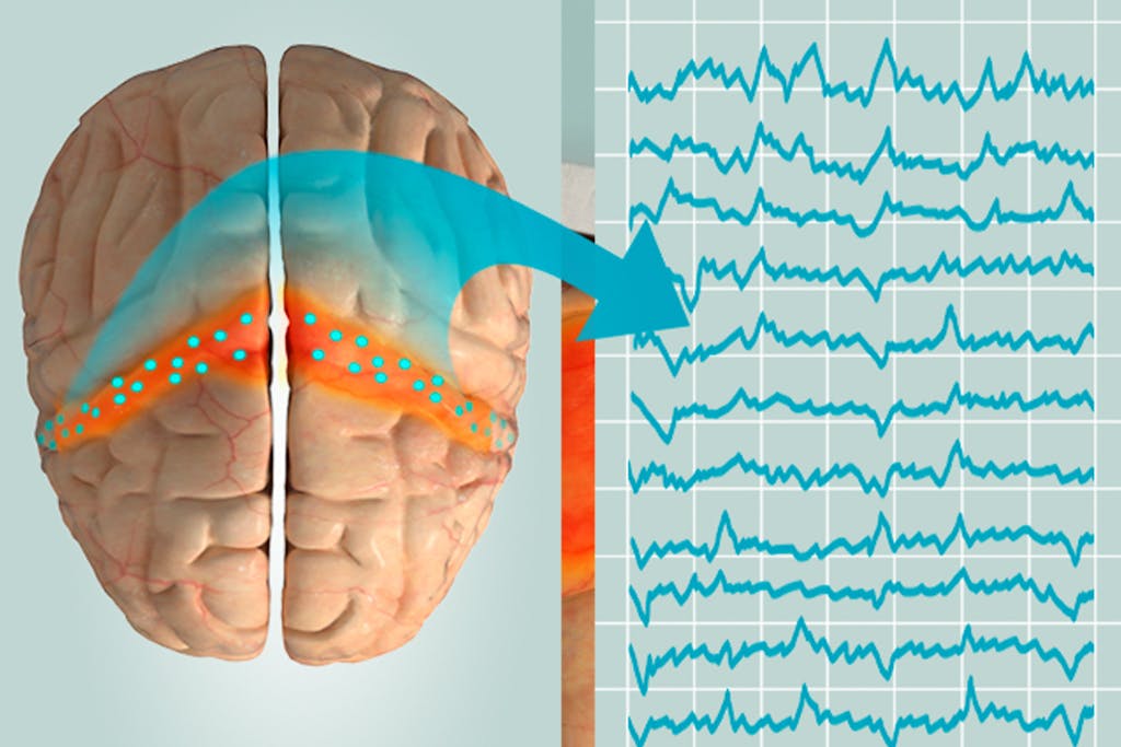 Neuralink: what you need to know about the new brain implant ...