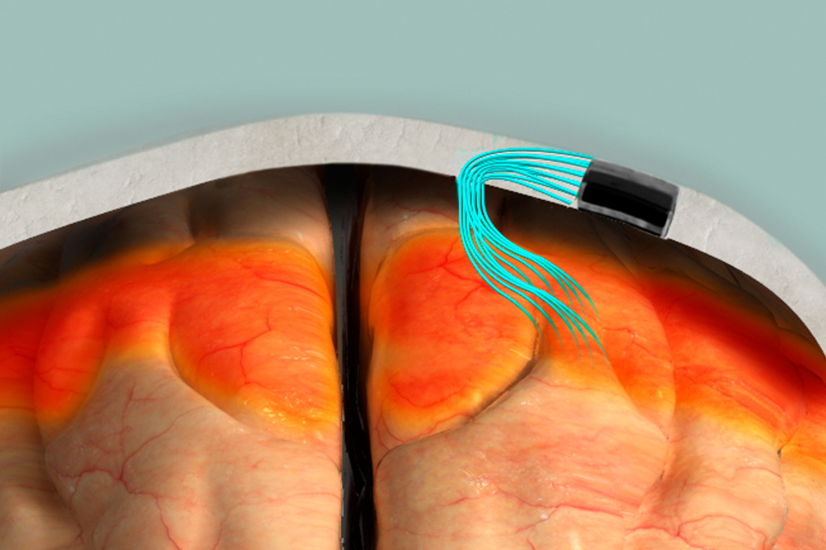 Neuralink: 6 things you need to know about the implant that connects ...