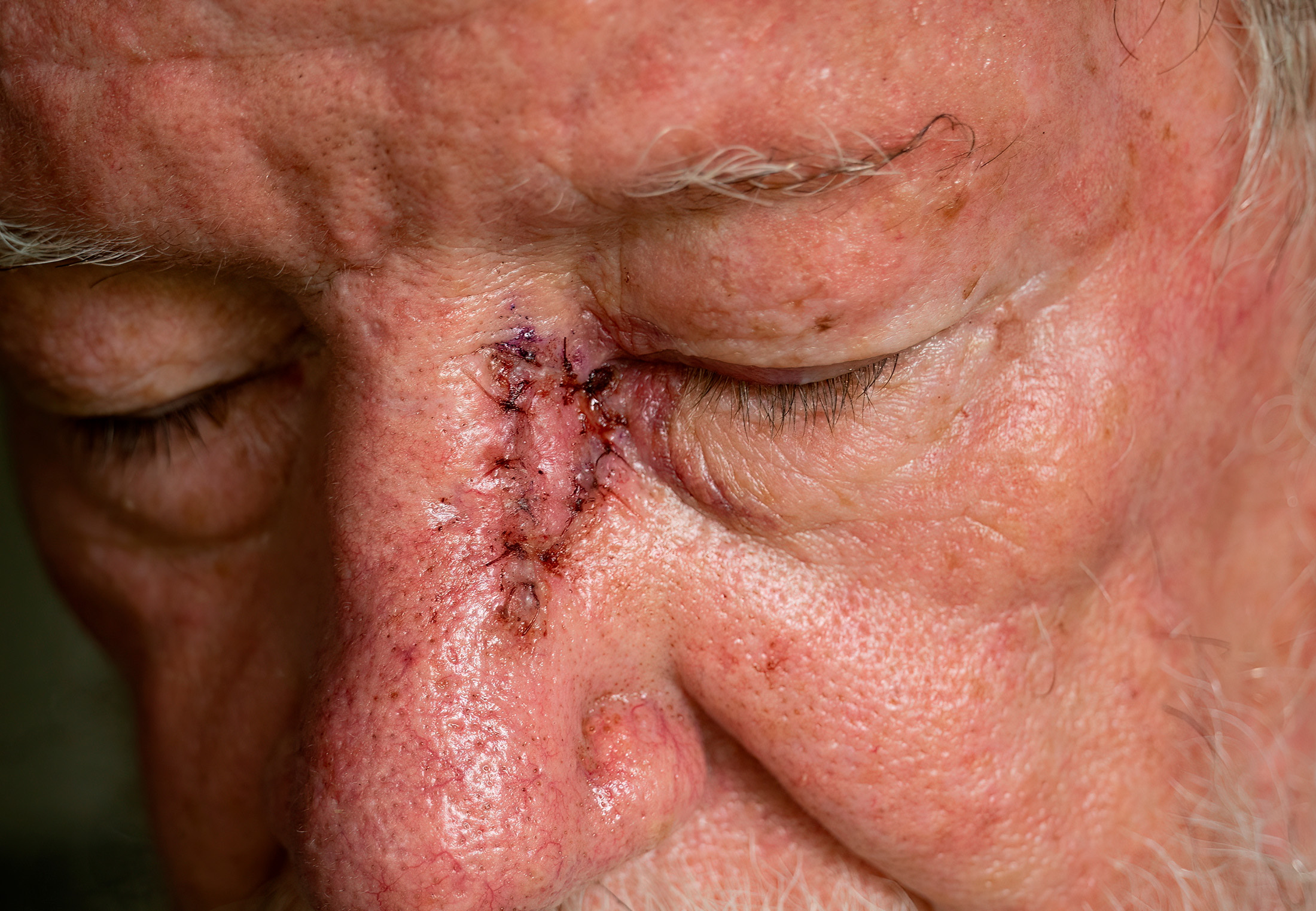 The ICAM1 protein makes elderly people more vulnerable to skin cancer ...