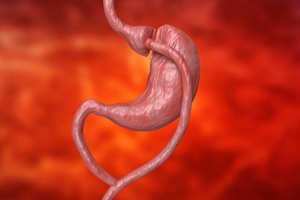 Nämä asiat pitää tietää diabeteksesta ja lihavuudesta | tieku.fi