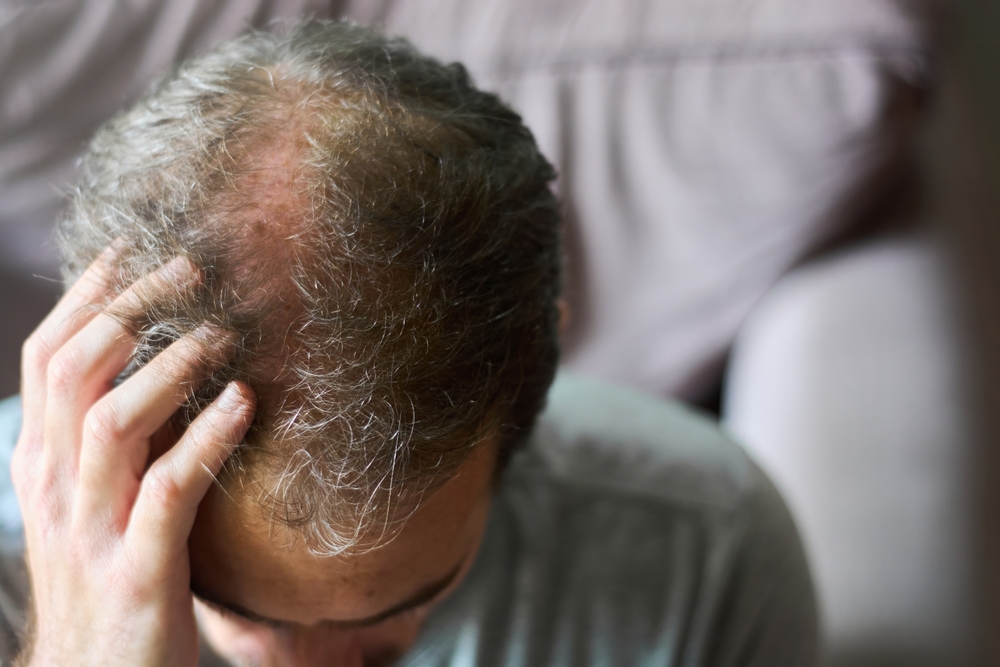 Nåle-plastre skal få håret til at gro igen for pletskaldede | illvid.dk