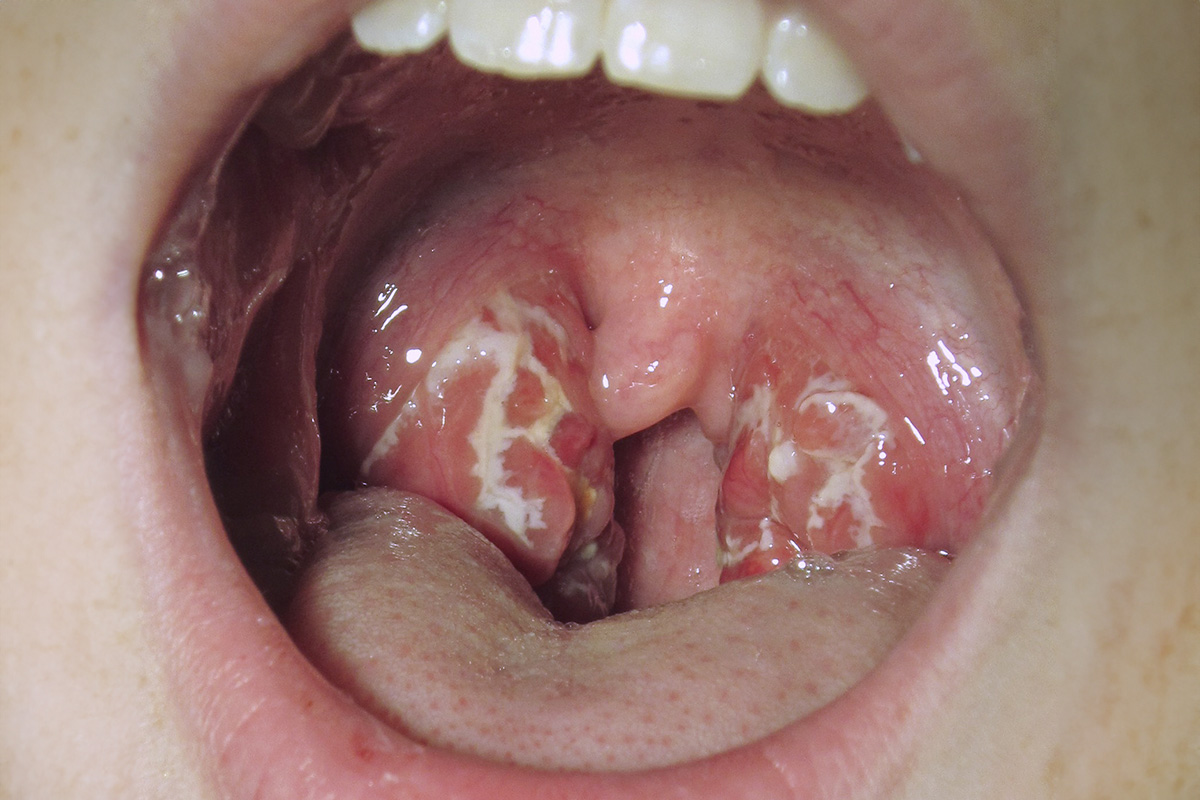 Mitä penisilliini on? | tieku.fi