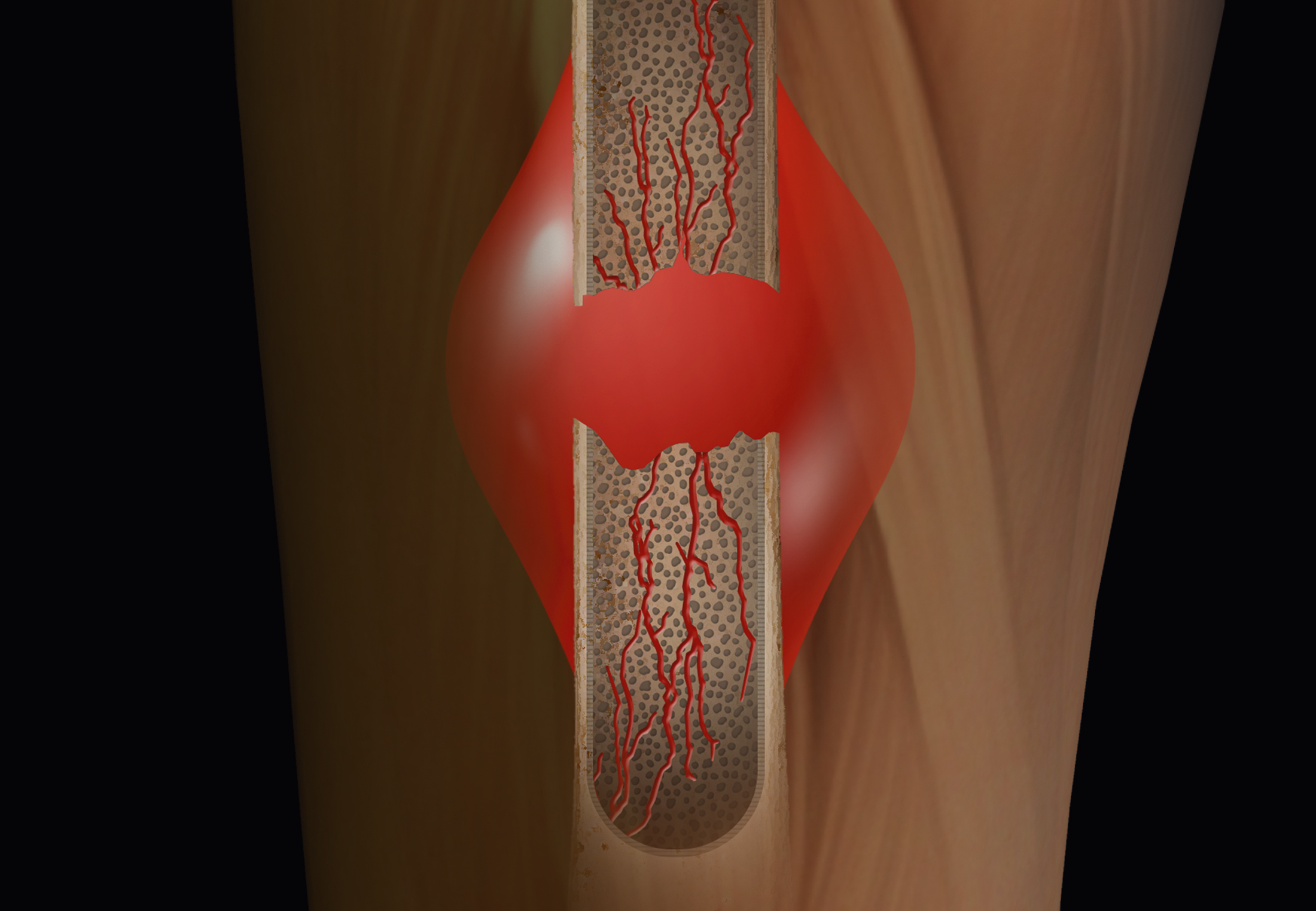 Knogle: Hvordan heler en brækket knogle? | illvid.dk