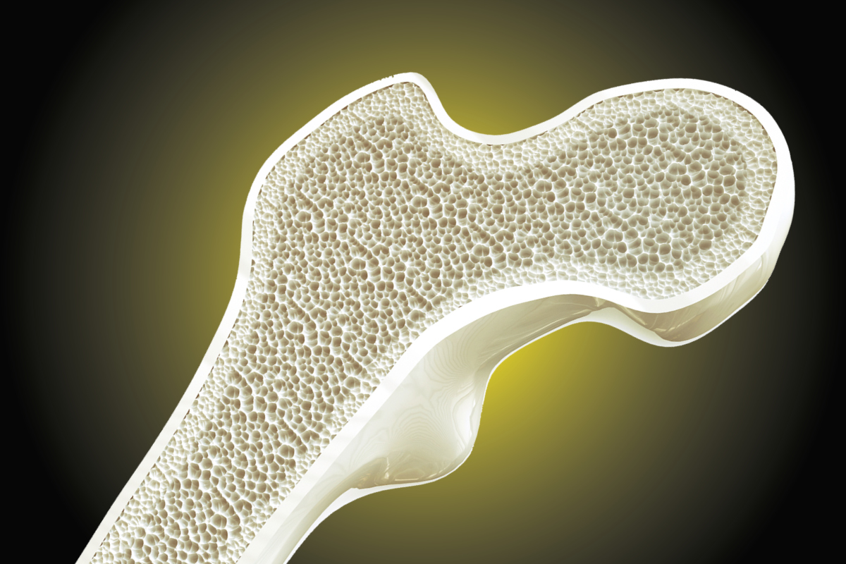 Osteoporose is een gebrek aan kalk en botweefsel | wibnet.nl