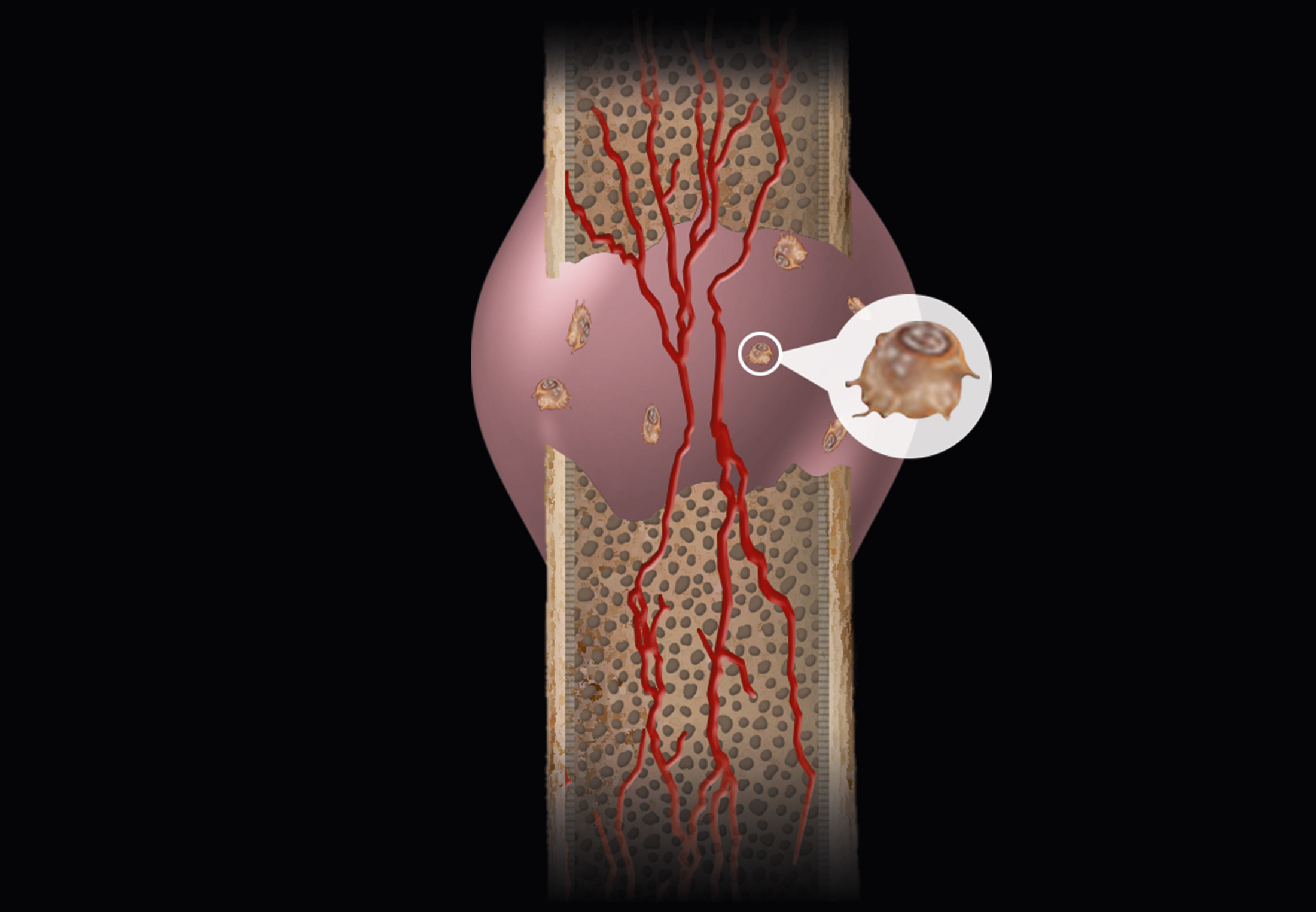 Knogle: Hvordan heler en brækket knogle? | illvid.dk