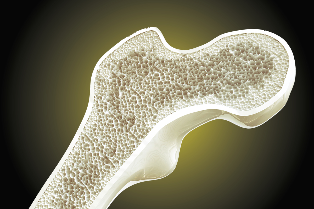 Osteoporose is een gebrek aan kalk en botweefsel | wibnet.nl
