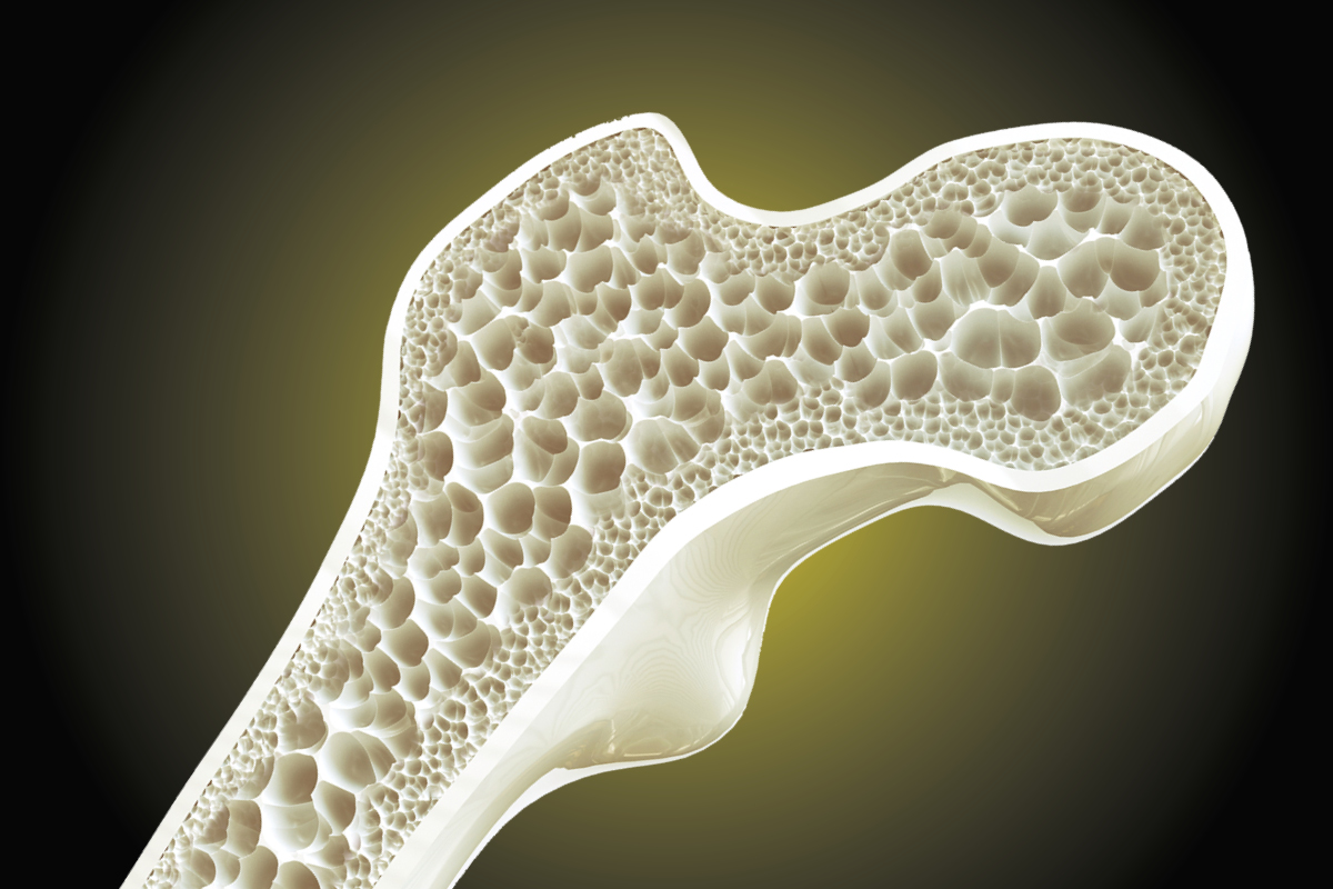 Beinskjørhet er mangel på kalsium og skjelettvev | illvit.no